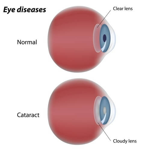 Advanced Cataract Surgery - Garrett Eye Center
