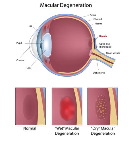Macular Degeneration Wet Vs Dry